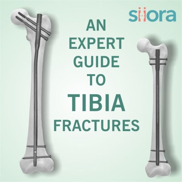 Tibia Fractures - An Expert's Guide