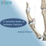 What Are Avulsion Fractures? - Siora Surgicals Private Limited