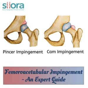 Femoroacetabular Impingement - An Expert Guide - Siora Surgicals