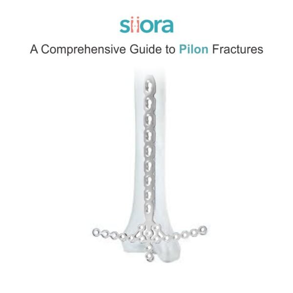 A Comprehensive Guide to Pilon Fractures - Siora Surgicals Private Limited