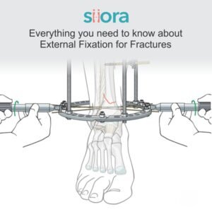External Fixation for Fractures: Effective Treatment