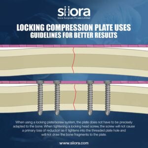 Uses & Benefits of Locking Compression Plates